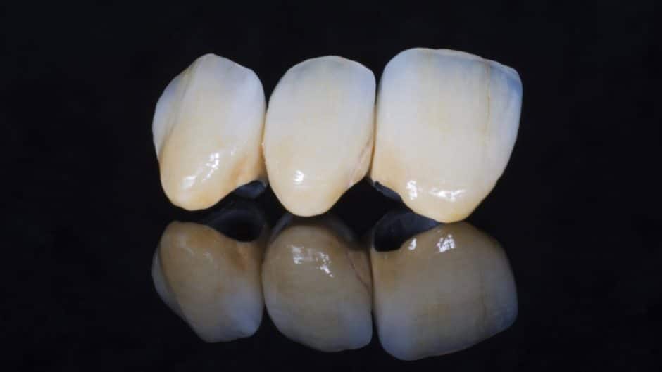 Protetika | Pearl dental